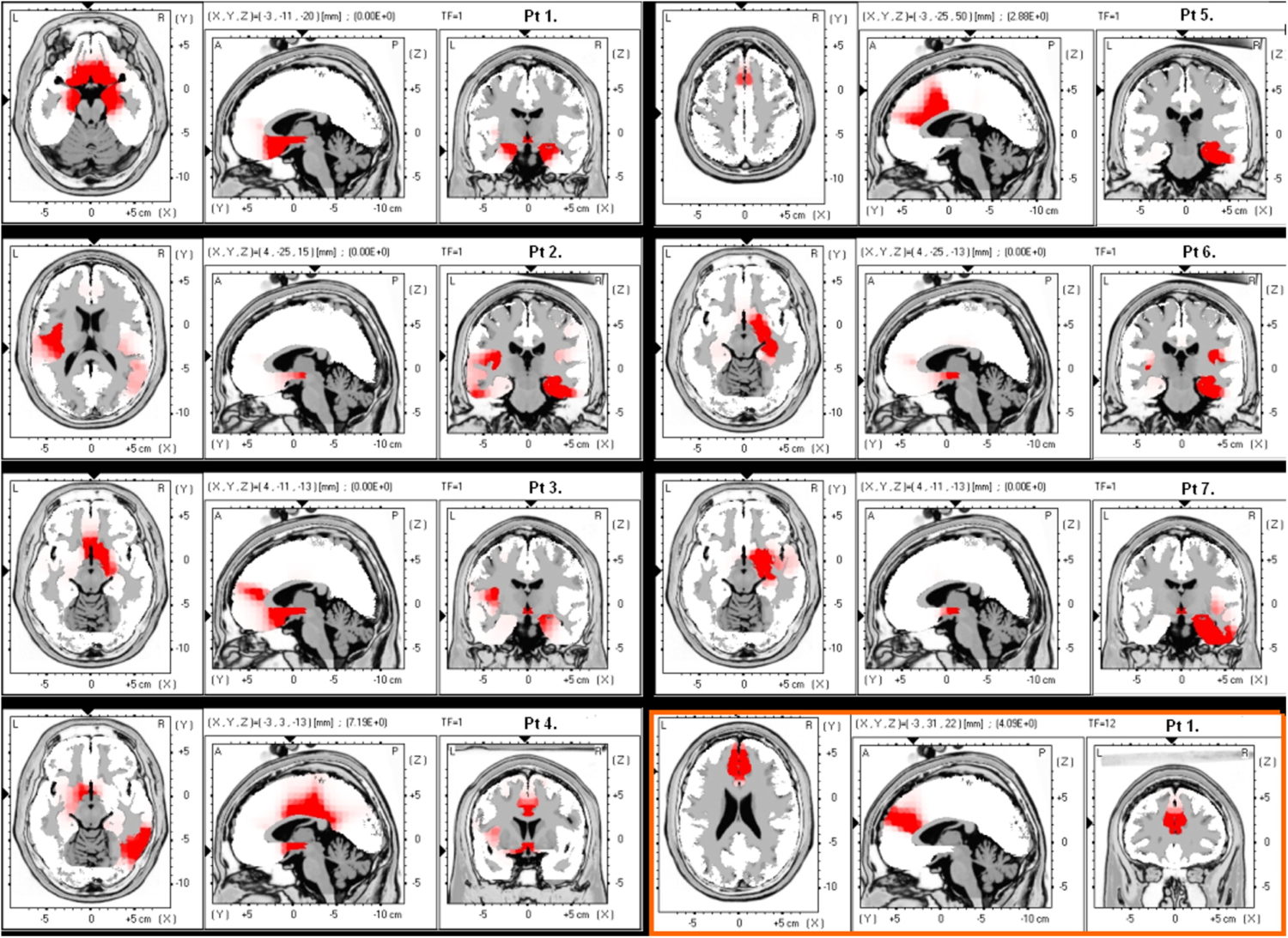 Anxiety, PTSD, and Depression – Niagara Neuropsychology
